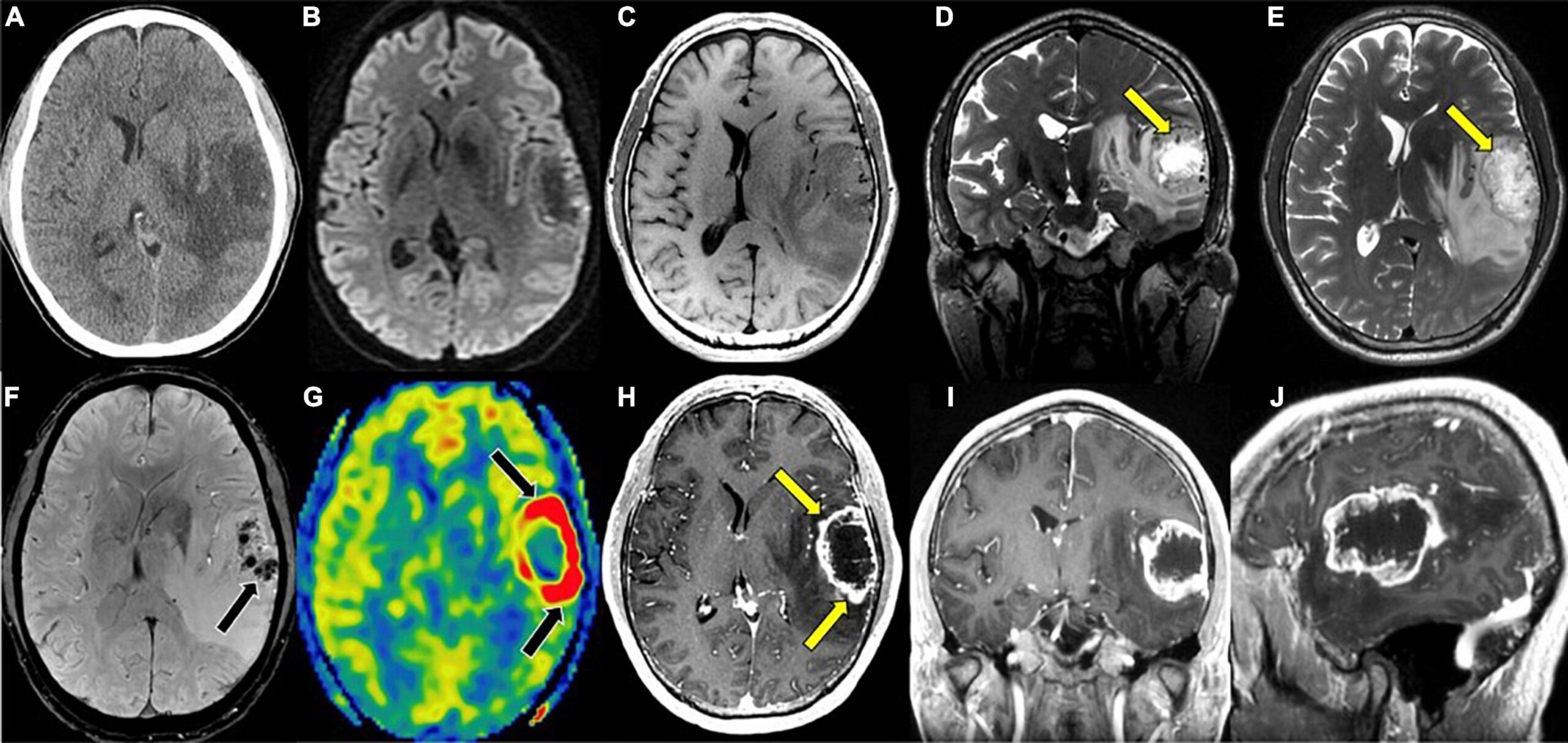 Abnormal Brain Mri Images Cancer