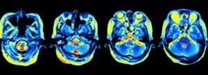 Functional MRI for Cognitive Assessments