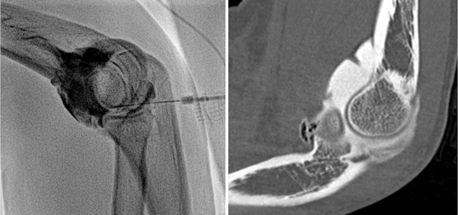 The Role of Arthrogram for Joint Injuries